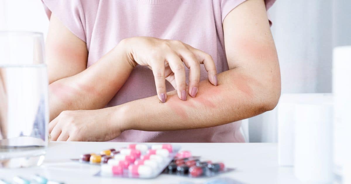 Allergic rash: What does it look like and when does it go away?