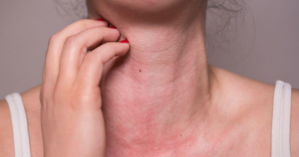Metal allergy: symptoms, causes and treatment